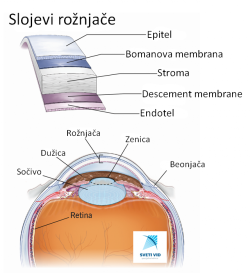 Transplantacija rožnjače - Sveti Vid